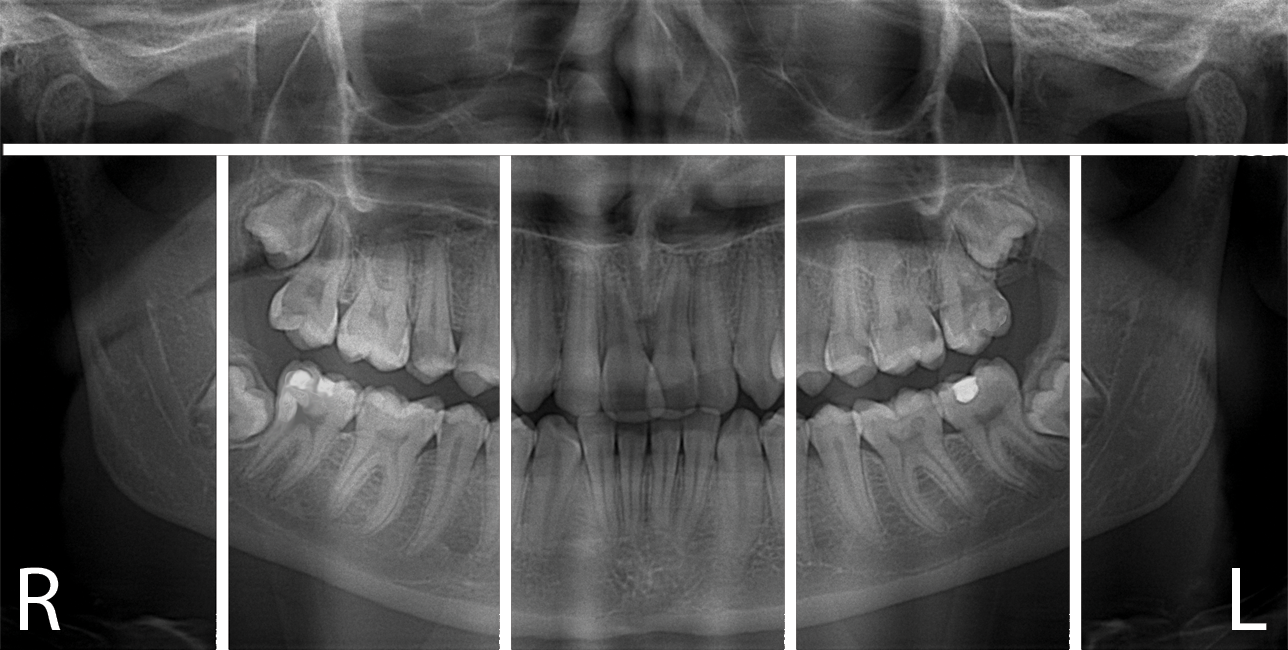 2D Digitalni Ortopan - Snimanje zuba Beograd - Rendgen centar Morita